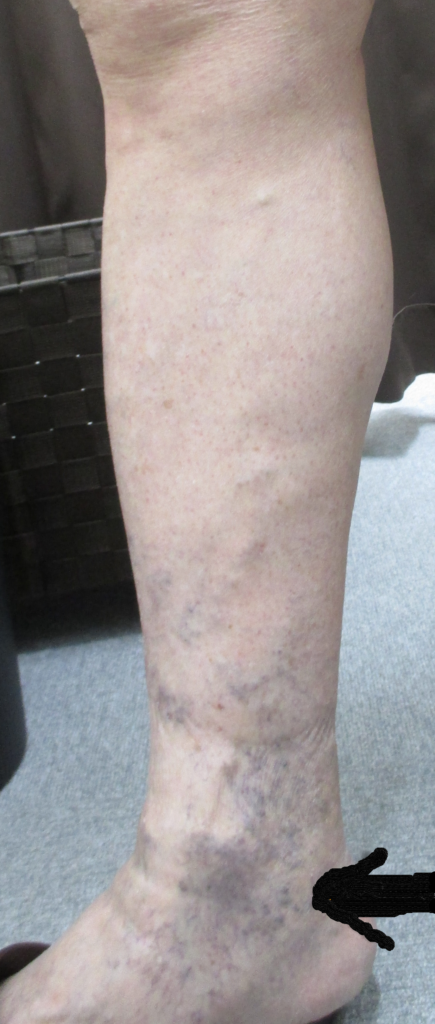 【Corona Phlebectaticaコロナ フレベクテイティカについて】 | 埼玉県の下肢静脈瘤クリニック｜さいたま静脈瘤クリニック